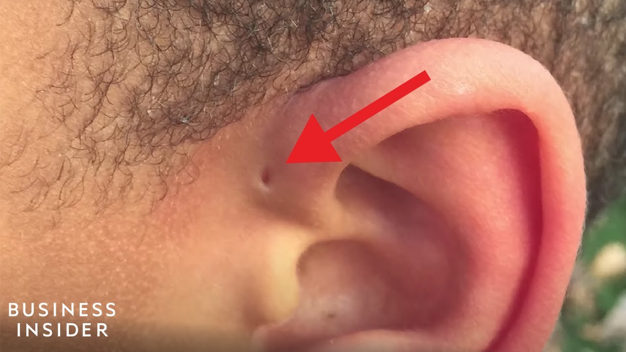 Explaining A Preauricular Sinus,  A Tiny Hole Above Some People's Ears