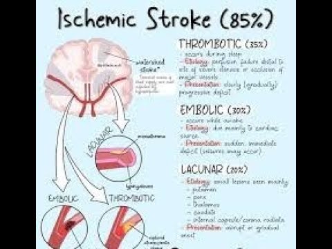 Types of Ischemic Stroke ; Embolic Stroke, Lacunar Stroke, Atherothrombotic Stroke