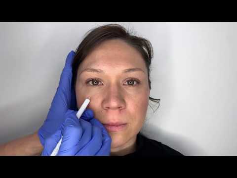Filler Assessment Essential Caucasian