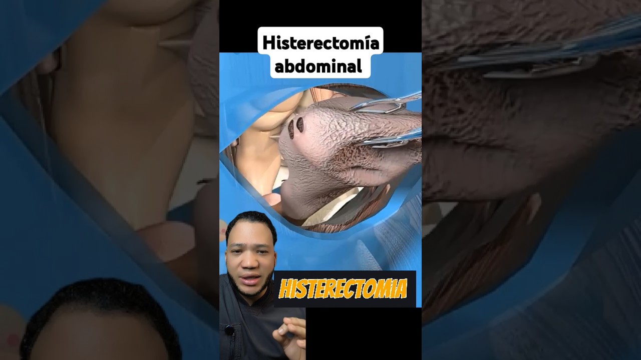 Abdominal hysterectomy: removal of the uterus through open surgery