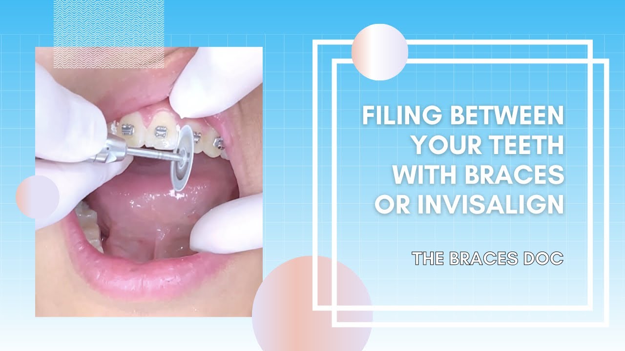 Braces - What is IPR, stripping or interproximal reduction?  Filing between your teeth and why!