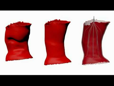 IVC Filter Placement Results: Left IVC