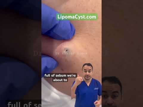 Expansive blackhead Dr Khaled Sadek LipomaCyst.com