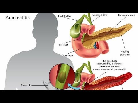 Common Disorders Of The Pancreas Doesn't Have To Be Hard, Here Are My Tips