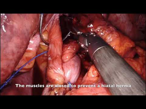 Robotic Esophageal Diverticulectomy for Esophageal Diverticulum