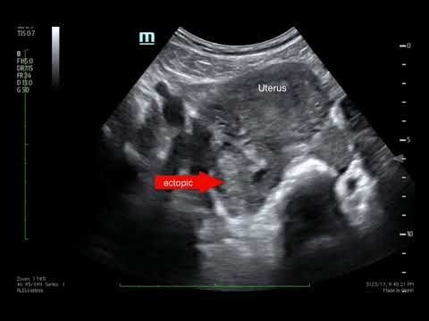 Ectopic Pregnancy, Ultrasound, Annotated JETem 2017