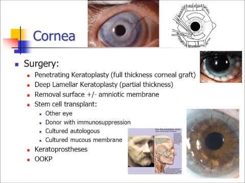 Aniridia – therapy and surgery | Aniridia Network