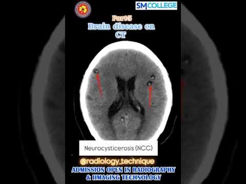 Unlocking Brain Health: Diagnosing Key Conditions with CT Scans