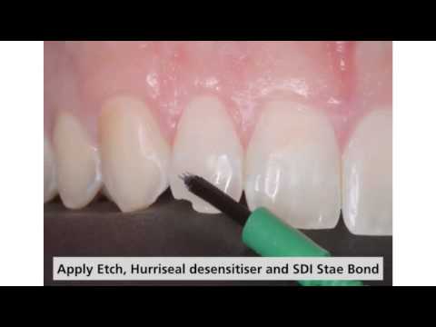 How-To: Anterior Dental Restoration with Aura from SDI