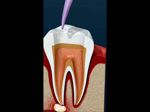 Why Root Canals FAIL
