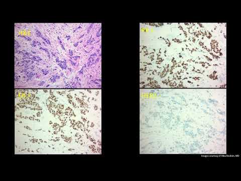 Introduction to the Molecular Subtypes of Breast Cancer - Sample