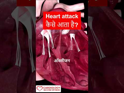 How does Heart Attack occur? #heartattack #heartdiseases #cardiologist