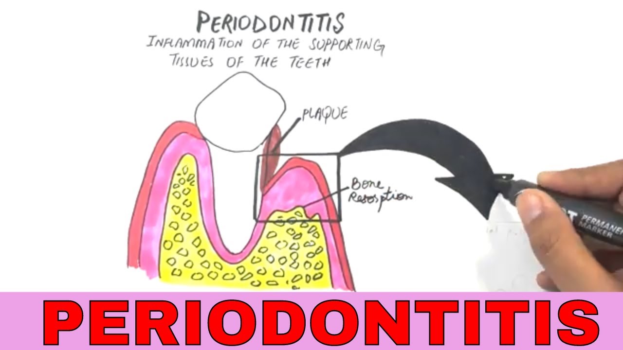 Periodontal Disease | Pathogenesis