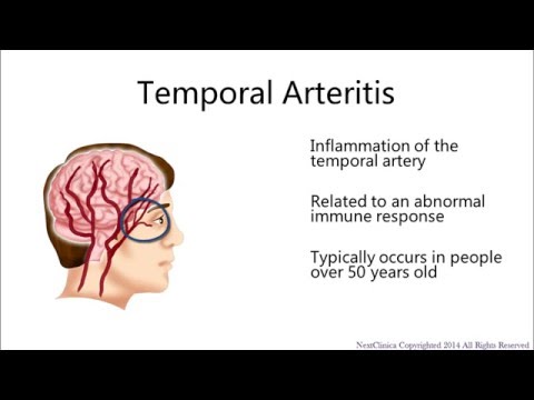 Temporal arteritis