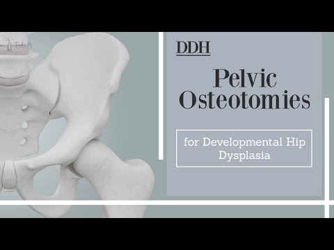 Pelvic Deformities – Pelvis Surgery