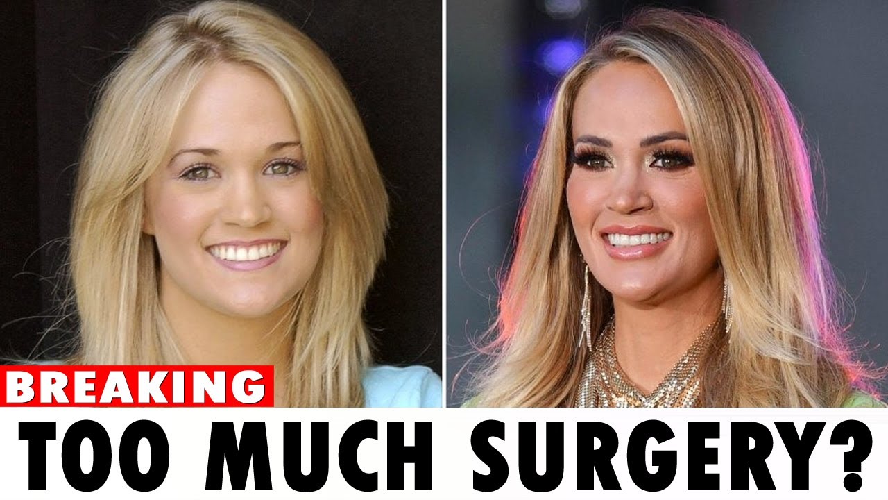 Carrie Underwood's Face Transformation: Too Much Surgery?