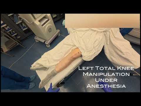 Manipulation Under Anesthesia (MUA) 4 months after left total knee replacement to address stiffness.