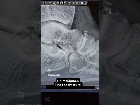 Find the fracture - navicular avulsion fracture and anterior process calcaneus fracture