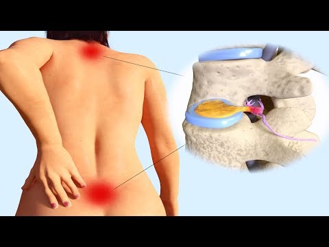 What is a Pinched Spinal Nerve and How is it Treated? | Dr. Steven Leckie