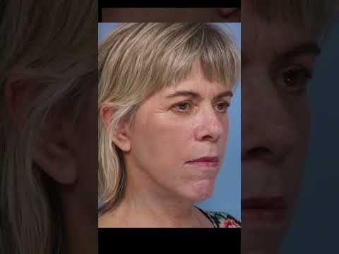 Facial Transformation | Bay Area's Top Facial Plastic Surgeons, Dr. Lieberman and Dr. Parikh
