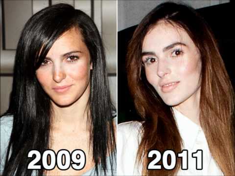 ALI lohan'd disgusting plastic surgery mistake!