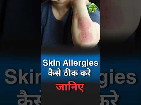 Skin Allergy Solution with Natural Ingredients | Vedic Upchar | @anilbansalayurveda | #shorts #skin