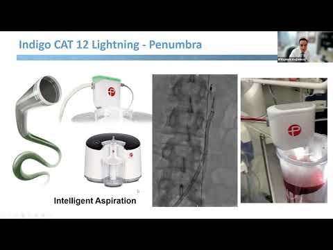 Review of Percutaneous Thrombectomy Devices for Iliofemoral DVT | Grand Rounds 2.10.2023