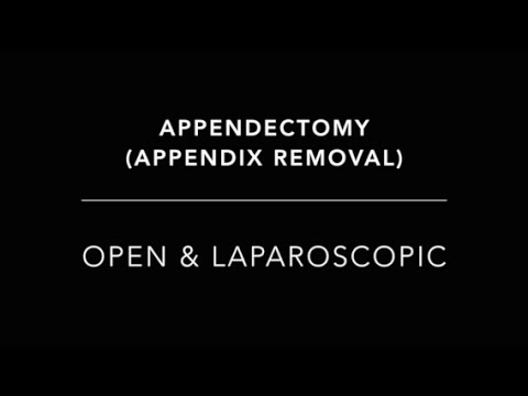 Laparoscopic Appendectomy (Appendix Removal)