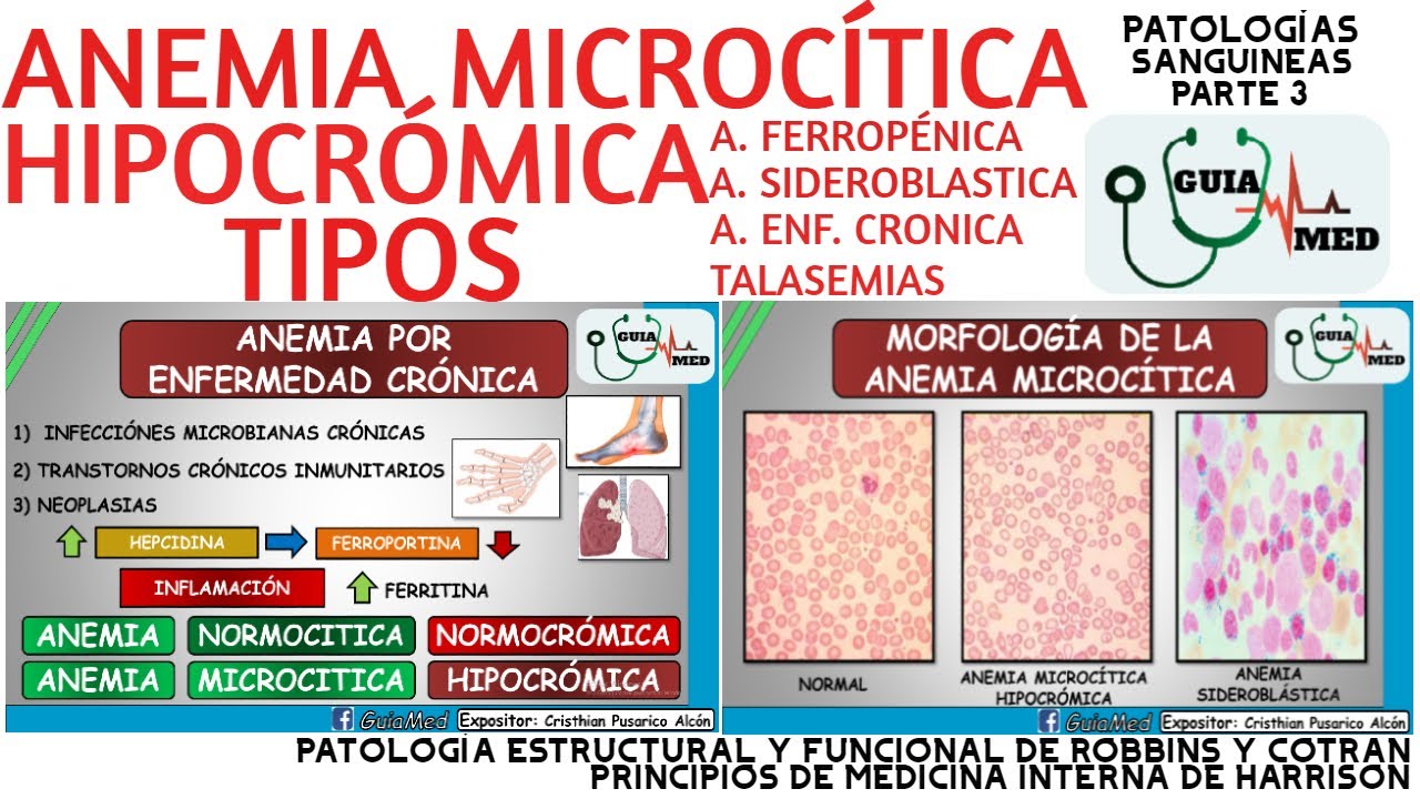 MICROCYTIC HYPOCHROMIC ANEMIA TYPES | GuiaMed