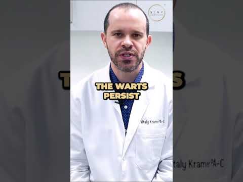 Wart treatment explained!