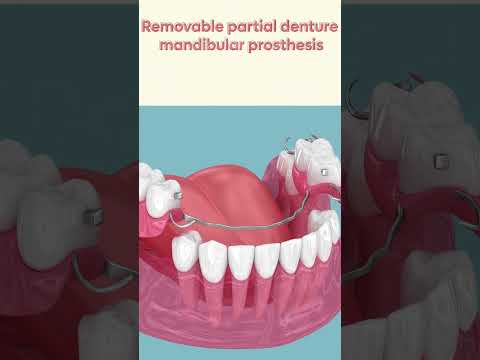 Still Missing Teeth? This Mandibular Partial Denture Changed Everything!