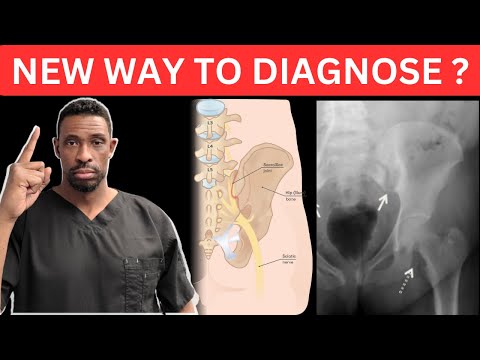 SI Joint Arthritis: A New Way To Diagnose An Old Painful Problem