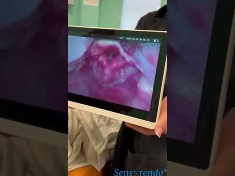 Clear view of the vocal cords with Sensorendo display for video laryngoscope #intubation #surgical