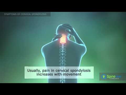 Spondiloza Cervicala :: KINETCARE CENTRO