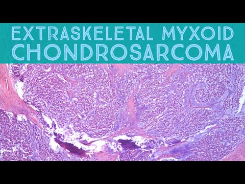 Extraskeletal myxoid chondrosarcoma (rare soft tissue tumor...not a real chondrosarcoma) pathology