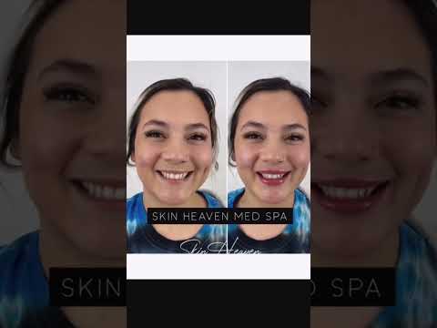 Lip Filler | Skin Heaven Med Spa #medspa #lips #lipfiller #skinheavenmedspa #oc #skinheaven #newlips