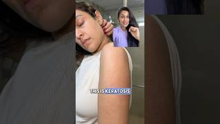 How did I treat my STRAWBERRY????SKIN/KERATOSIS PILARIS? #strawberryskin