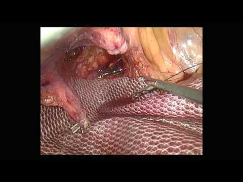 Laparoscopic surgery for combined left groin and left corner of Pfannenstiel incision hernia