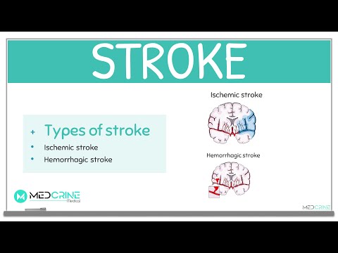 Stroke: Definition, Classification, Causes, Symptoms, Diagnosis, and Treatment