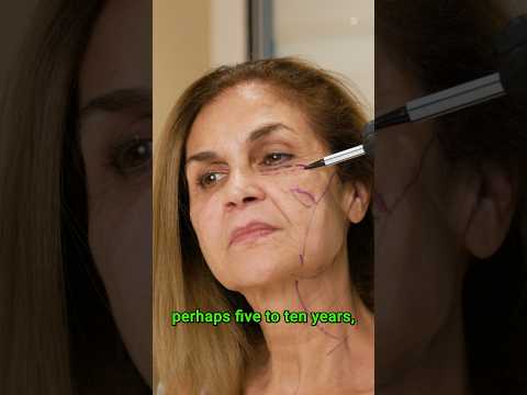 Gita’s GORGEOUS Transformation✨😍 #antiaging #facelift