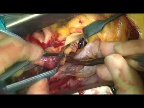 Commando Procedure as the Optimal Solution for DVR in Small Annuli with Severe MAC (Unedited)