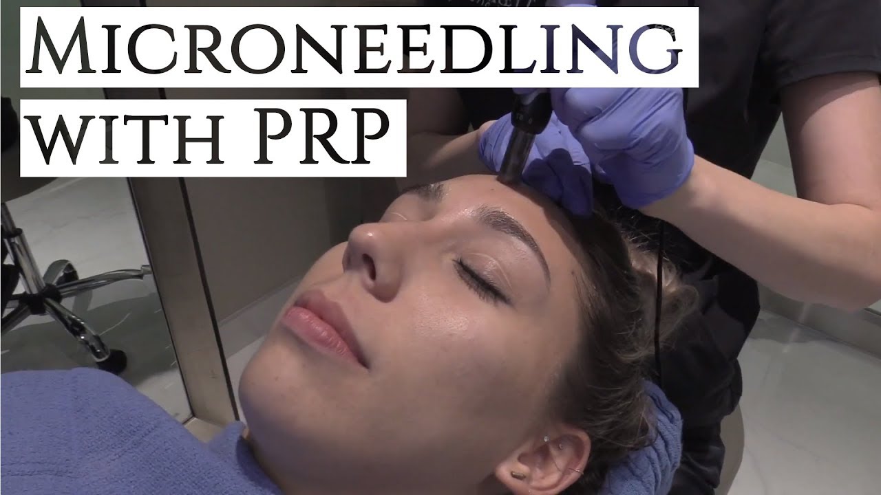 Microneedling with PRP | Skin Care | Treat Pores and Wrinkles | Barrett Med Spa | Beverly Hills