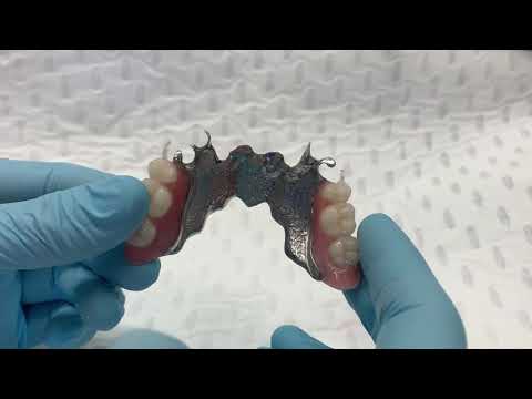 Chrome Dentures | 45+ Years Experience | Metal Partials