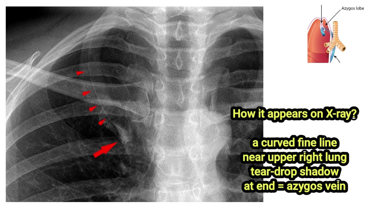 Azygos Lobe - Anat THORAX 