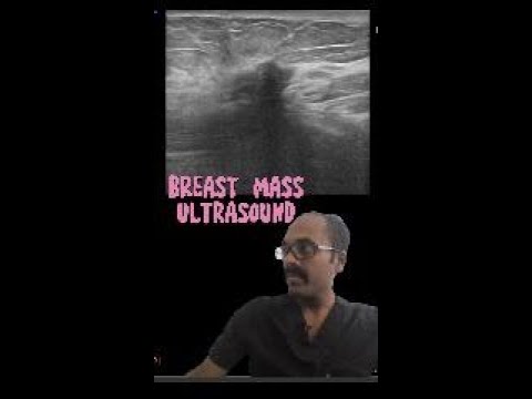 Breast Mass on Ultrasound