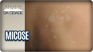 Micose: causas e tratamentos