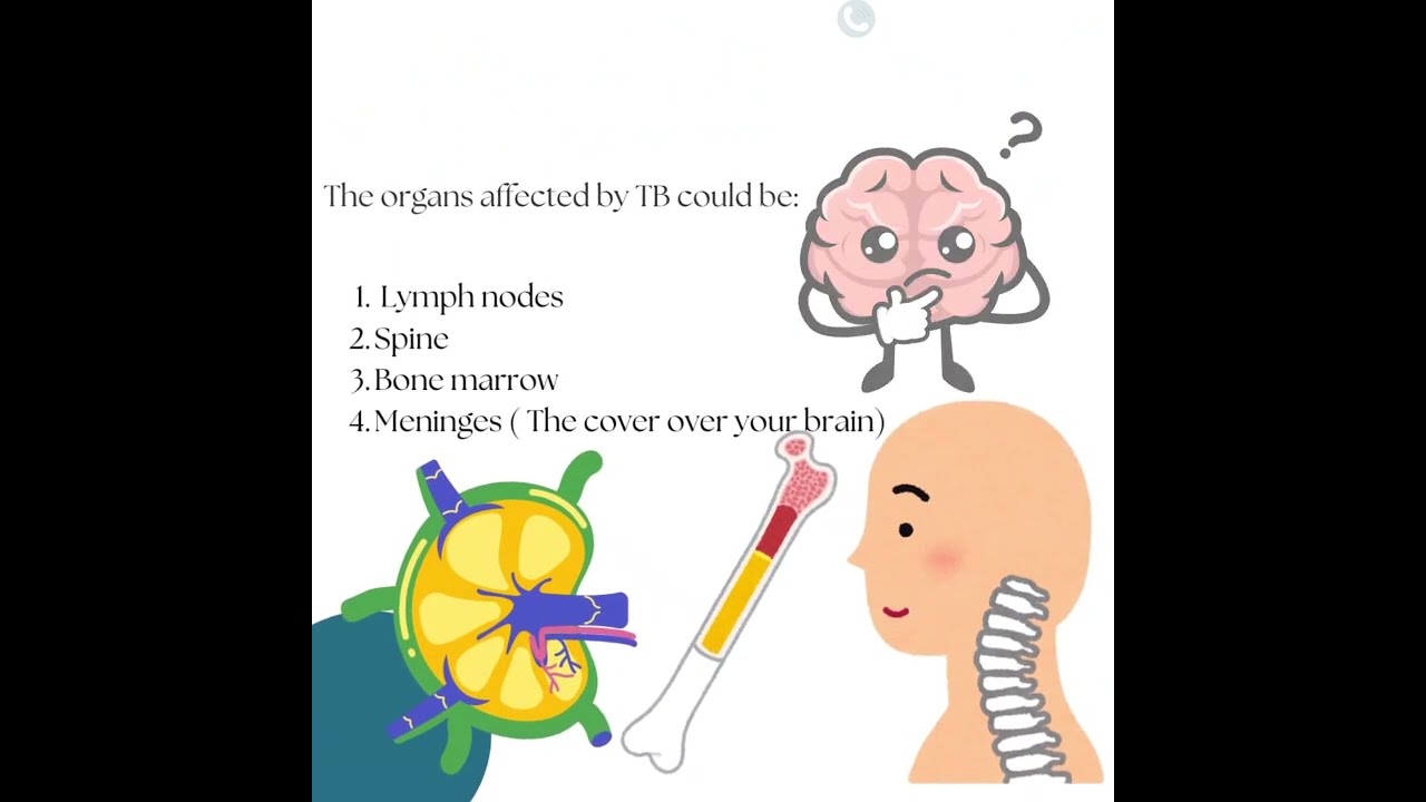 Neck swellings-4- TB Lymph node-How does it present?#ourvadodara #enthealth #neck #tuberkulosis