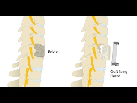 Vertebral corpectomy CPT code - simplify medical coding