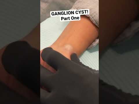 SHORT: GANGLION CYST!