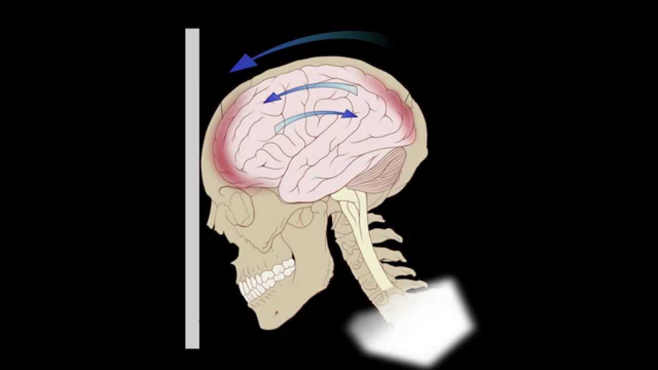 Common Brain Injuries: Coup-contracoup
